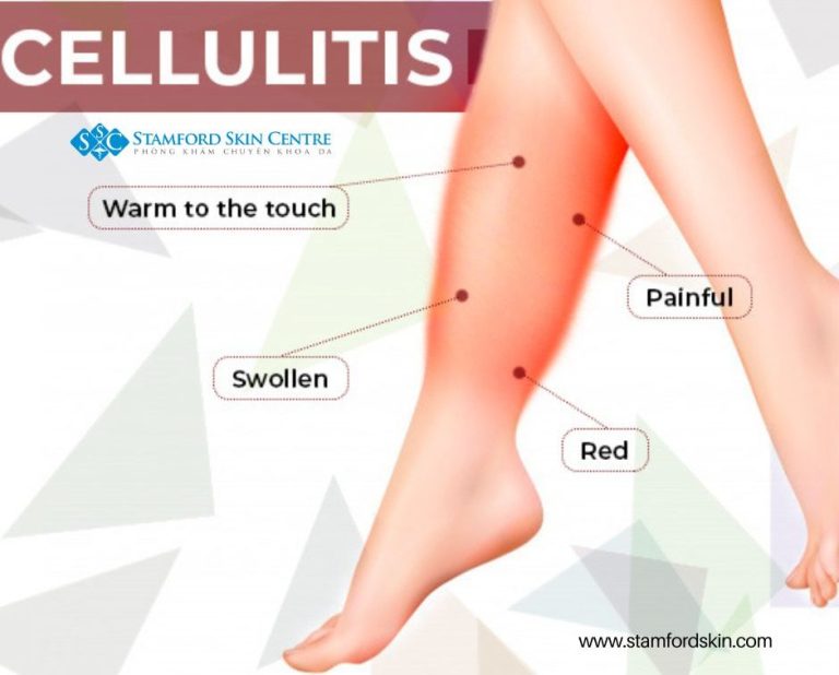 Mengenal Selulitis dan Kapan Harus Memeriksakannya ke Dokter | Portal ...